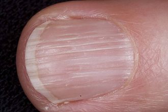 Nail Clubbing: Early Signs, Progression Stages, and Medical Treatments
