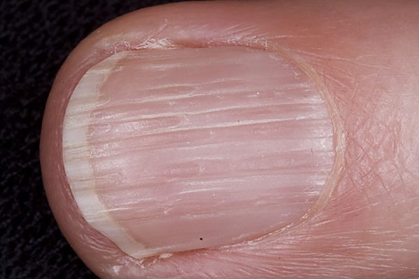 Nail Clubbing: Signs, Stages and Treatment – NailDesignCode
