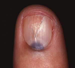 Lunula of Nails: What It Says About Your Health? – NailDesignCode