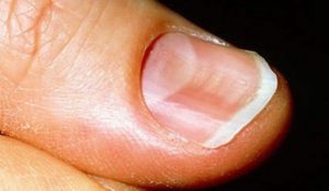 Spoon Nails (Koilonychia) 101: Causes, Symptoms, and Treatments