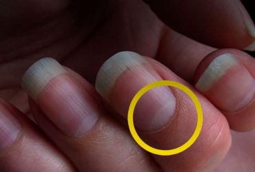 Mucous Cyst on The Fingers: Symptoms & Treatment – NailDesignCode